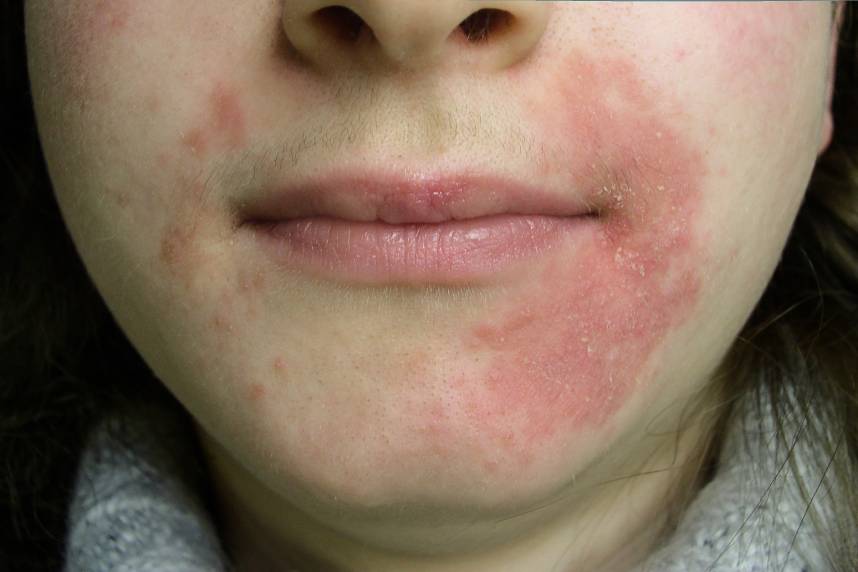 Nadar Estoy Feliz Propuesta Dermatitis Perioral Pomada Calina Cort s 