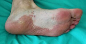 Liquen Plano, Síntomas, Causas y Tratamiento - Dr. Gabriel Serrano